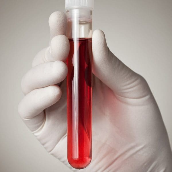 CBC (Complete Blood Count) with Differential & Platelet Count – Test ...